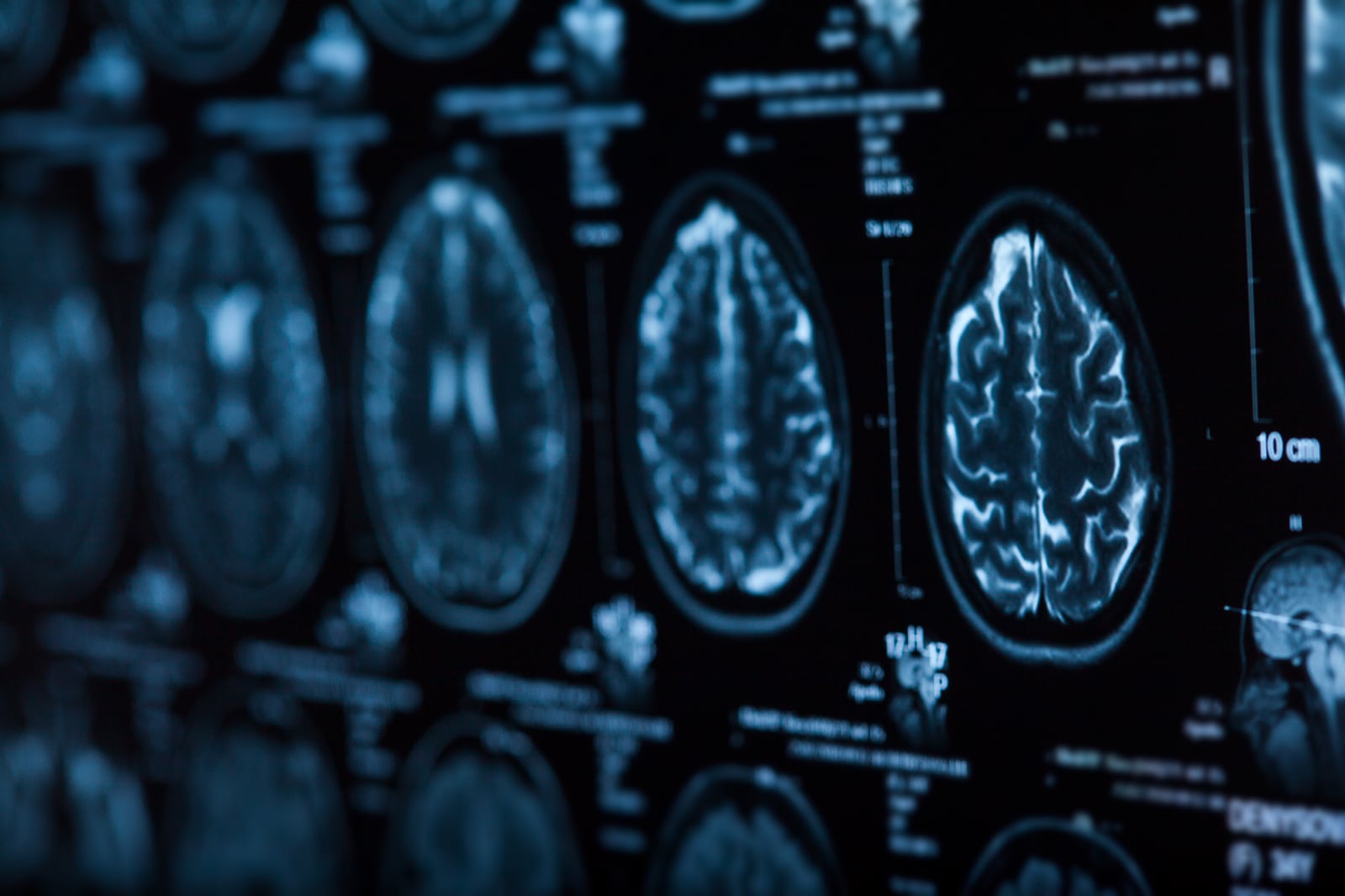 Evozierte Potentiale – Neuropraxis Dachau